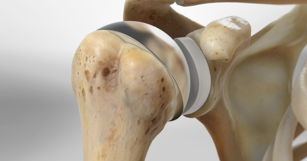 Exploring Non-Surgical Alternatives to Shoulder Replacement Surgery